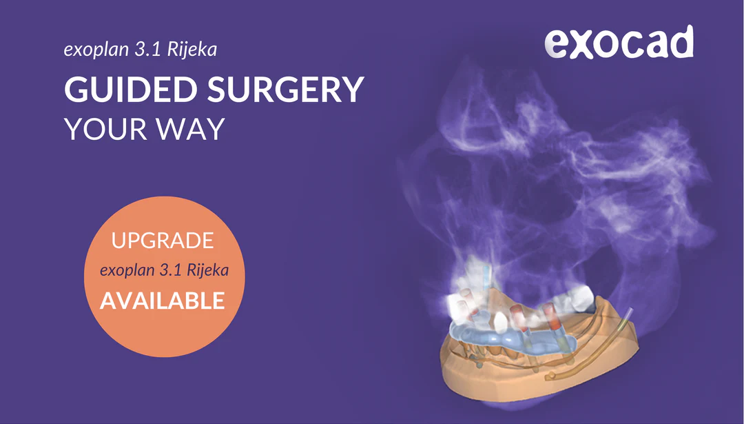 exocad exoplan implant planning and surgical guide design