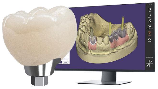 Dental Implant Crown Outsourcing with Imagine USA