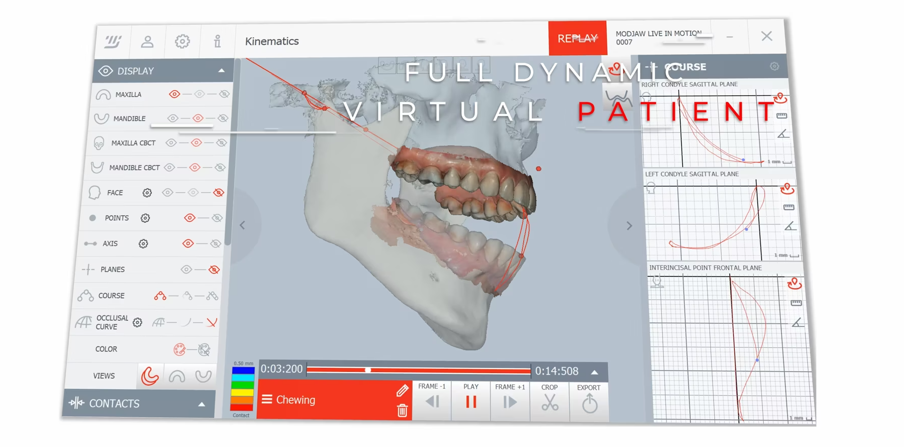 MODJAW Jaw MOTION Tracking and Dynamic Occlusion