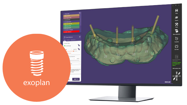 exocad exoplan implant planning and surgical guide design